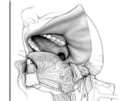 Cancer Of Buccal Mucosa | Dr Rahul Buggaveeti | Hyderabad